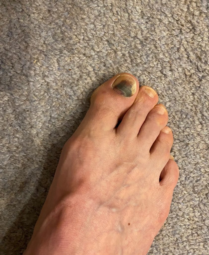 What is Hikers Toe and Should you be Worried? - Kayde Parker